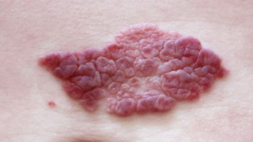 Angiome de bébé : définition, traitement... | Pharmacie Des Drakkars