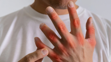 La goutte : cause, symptômes, diagnostic, traitement... | Pharmacie Des ...