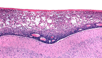 La méningite : origine, symptômes & traitement | Pharmacie Des Drakkars