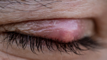 Orgelet : définition, traitement et prévention | Pharmacie Des Drakkars