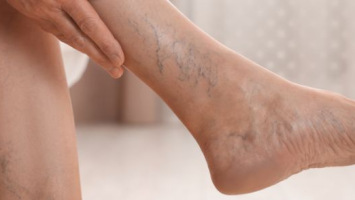 Varices : comment les reconnaître et que faire ? | Pharmacie Des Drakkars