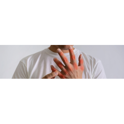 La goutte : cause, symptômes, diagnostic, traitement... | Pharmacie Des ...