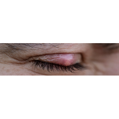 Orgelet : définition, traitement et prévention | Pharmacie Des Drakkars